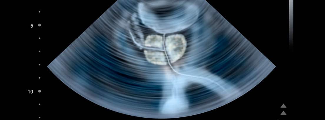 ¿Como se hace una ecografía vesico-prostática? -canalSALUD