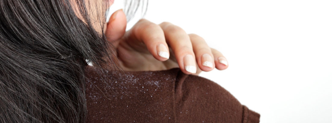 ¿Qué es la caspa y cómo la elimino? -canalSALUD