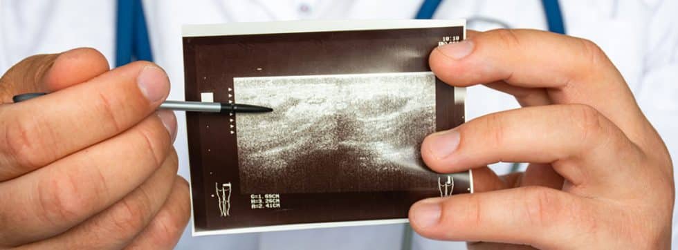 ¿Qué es el quiste pilonidal o sacro y cómo se trata? - canalSALUD