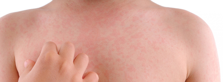 ¿Qué causas producen eritema infeccioso? -canalSALUD