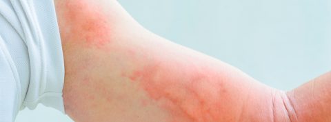 Urticaria solar: cómo afecta y qué pruebas pueden hacerte- canalSALUD