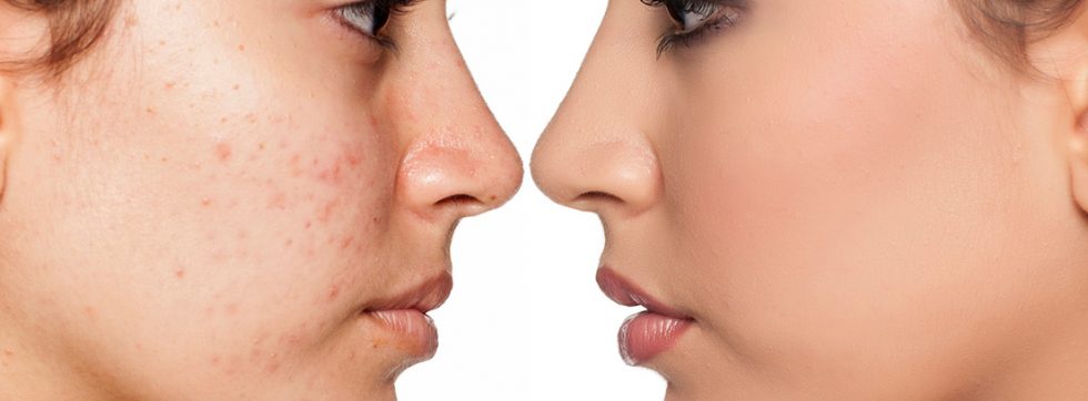 Tipos de piel, seca, normal, mixta, sensible - canalSALUD