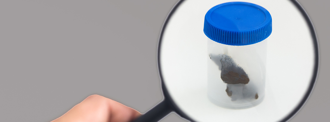 Causas de sangre en las heces -canalSALUD