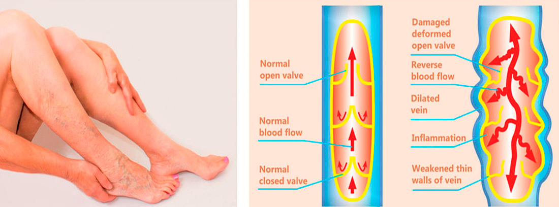 ¿Qué es la insuficiencia venosa crónica? –canalSALUD