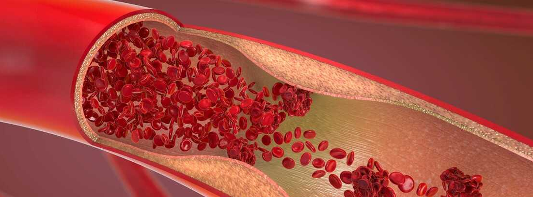 Policitemia Vera, diagnóstico y tratamiento -canalSALUD