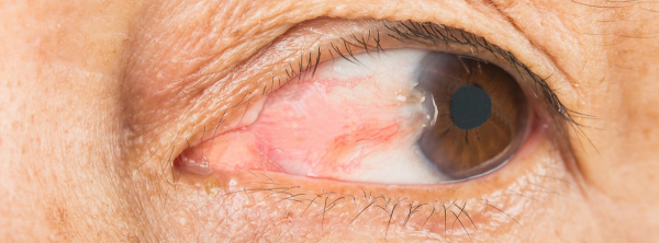 Que es el Pterigión y como tratarlo -canalSALUD