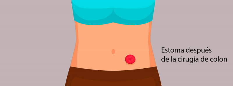 Colectomía o extirpación del colon: consecuencias -canalSALUD