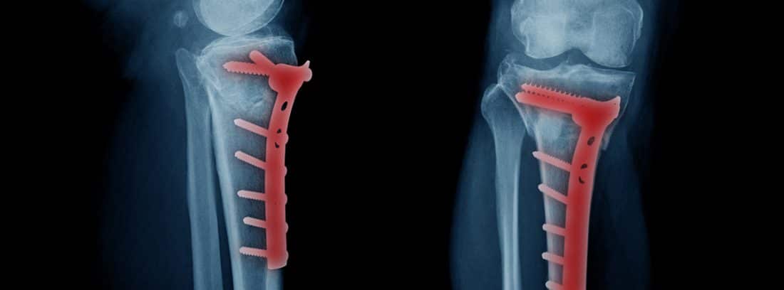 Osteosíntesis: tipos, materiales y más -canalSALUD