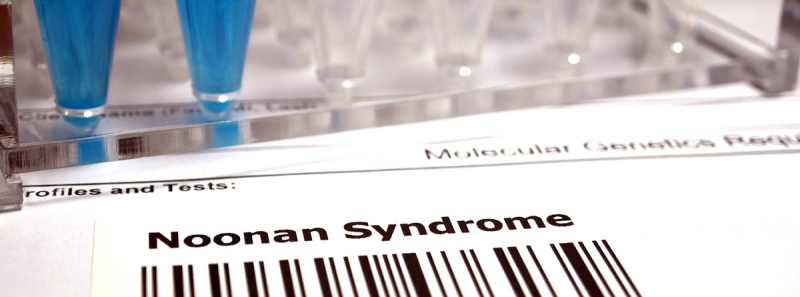 Síndrome de Noonan, causas y tratamiento -canalSALUD