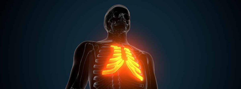 ¿Se puede prevenir la costocondritis? -canalSALUD