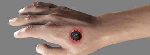 ¿Cómo se contagia el carbunco y cómo se trata? - canal SALUD