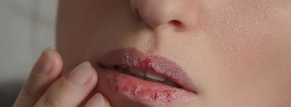 ¿Cómo curar los labios cortados o agrietados? -canalSALUD