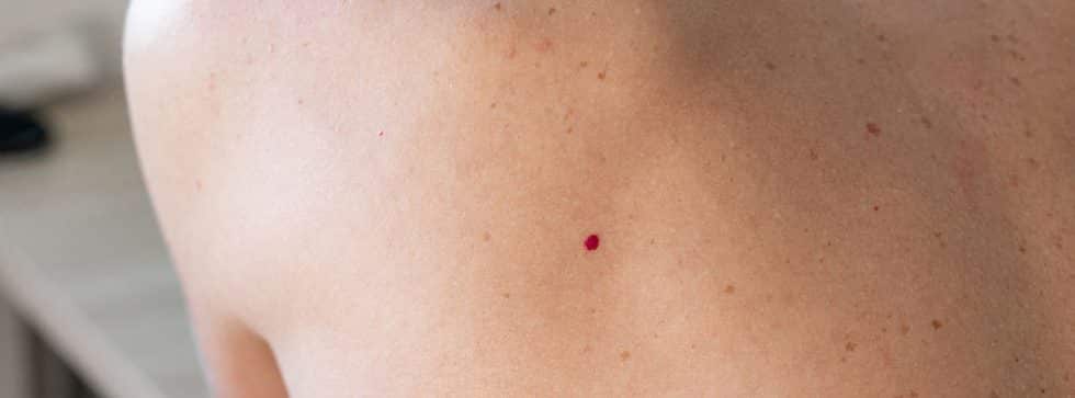 Petequias, síntomas, causas y tratamiento -Blogs MAPFRE