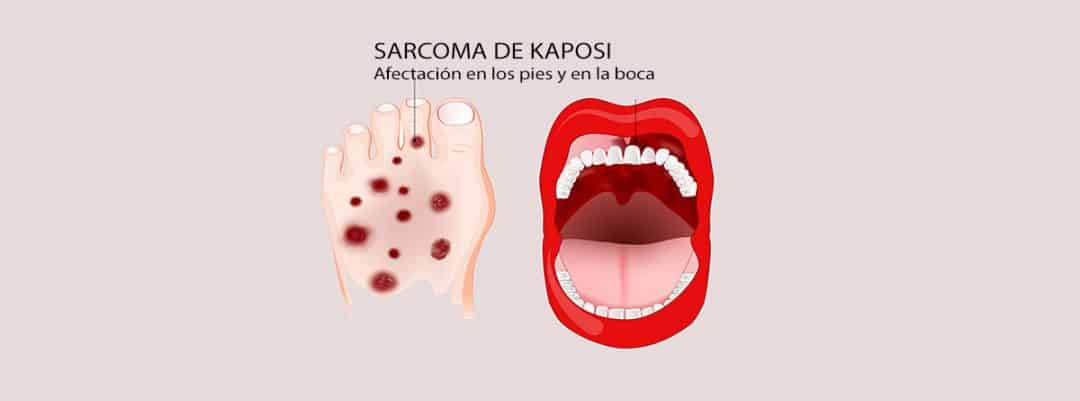 ¿Por qué se produce el sarcoma de Kaposi? -canalSALUD