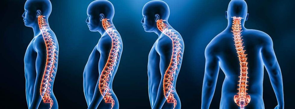 Cifosis dorsal: causas, diagnóstico y tratamiento -canalSALUD