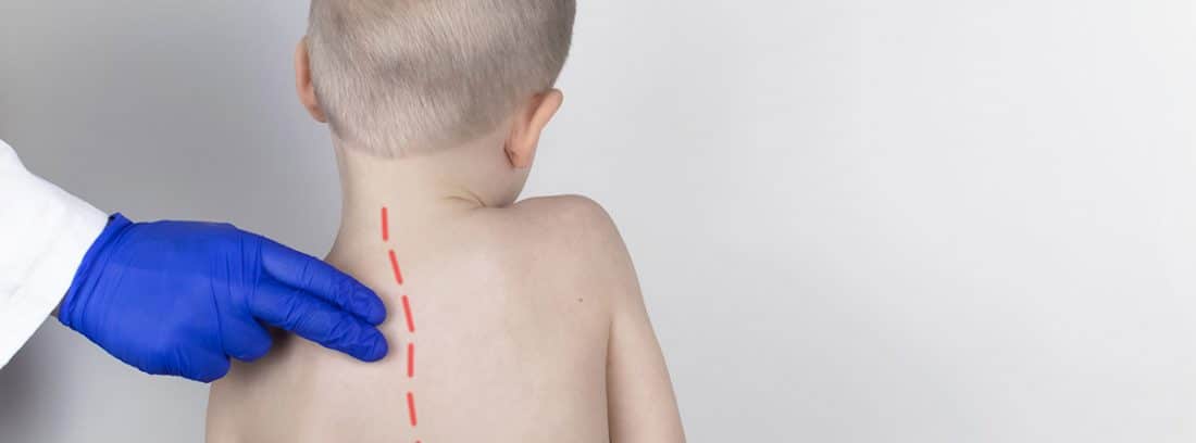 Cifosis dorsal: causas, diagnóstico y tratamiento -canalSALUD