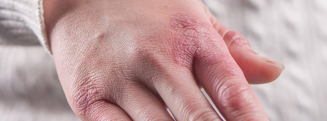 Alergia al frío o urticaria a frígore -canalSALUD