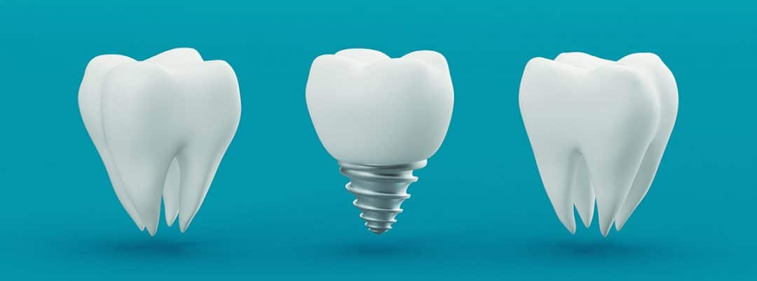 Coronas dentales y tipos -canalSALUD