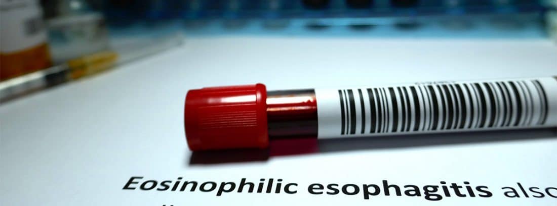 Esofagitis eosinofílica: tratamientos, alimentación -canalSALUD