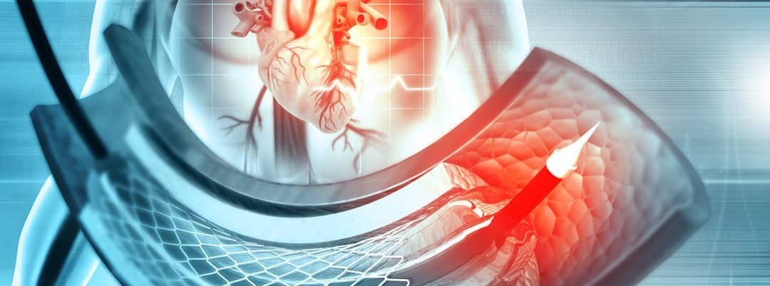 Anuloplastia: cómo y cuándo se realiza- Blogs MAPFRE