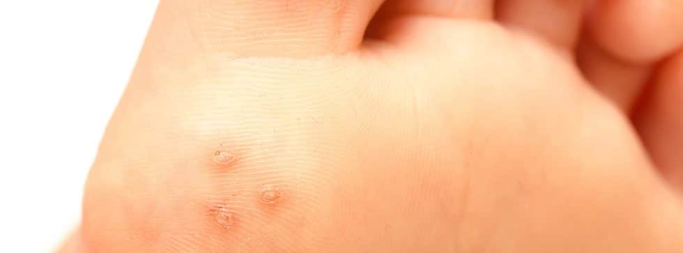 Tengo un papiloma en el pie, ¿cómo se cura? - Blogs MAPFRE