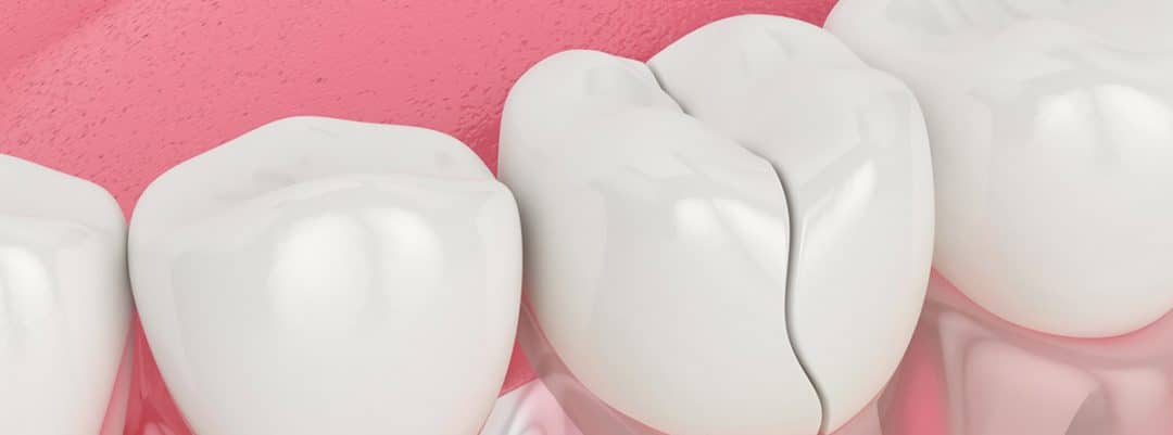 Qué hacer con una muela rota si no duele - Blogs MAPFRE