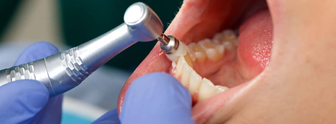 Qué hacer con una muela rota si no duele - Blogs MAPFRE