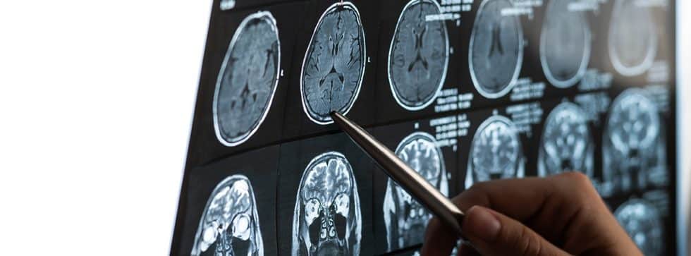 Pérdida de líquido cefalorraquídeo: causas y consecuencias - Blogs MAPFRE