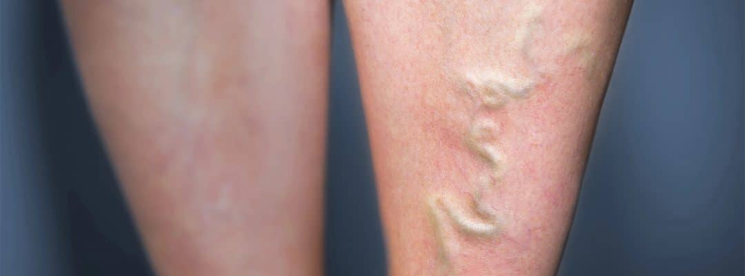 Qué es una flebitis - Blogs MAPFRE