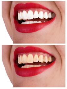 El color de los dientes ¿ de qué depende?