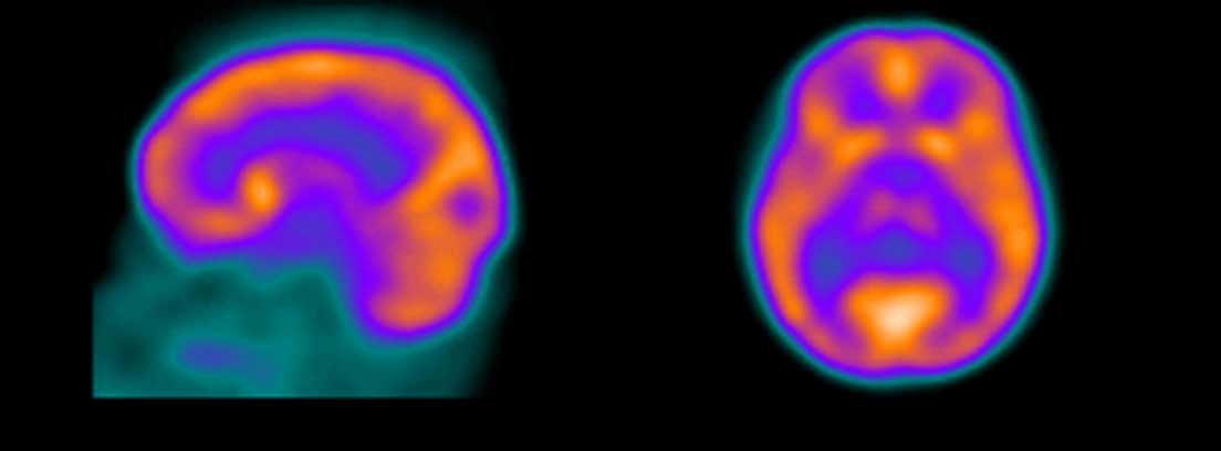 ¿Qué es el SPECT cerebral y para qué sirve? -canalSALUD