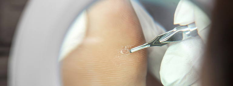 Tratamiento del clavo plantar o callo -Blogs MAPFRE