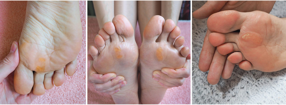 Tipos de callos en los pies -Blogs MAPFRE