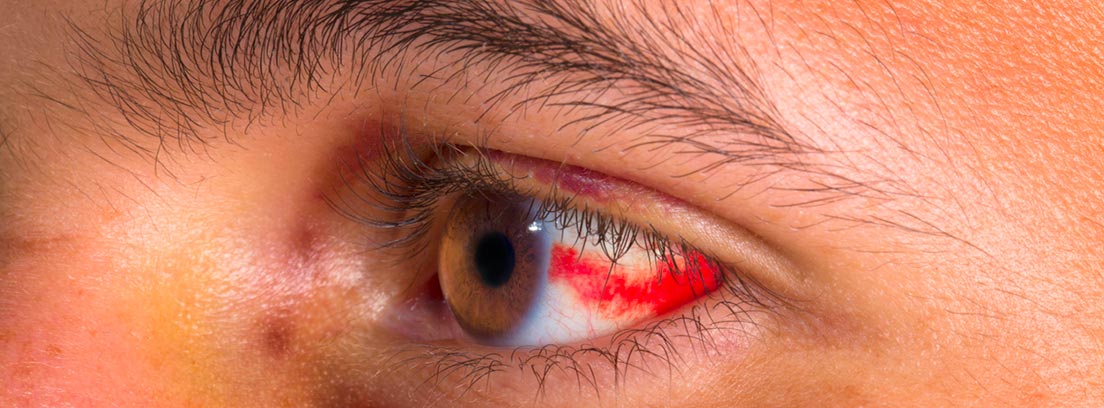 Derrame en el ojo, causas y soluciones -canalSALUD