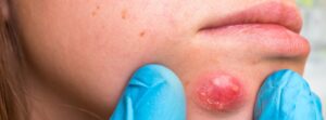 Foliculitis: tratamiento y prevención -canalSALUD