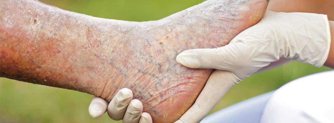 Enfermedades reumáticas panarteritis nodosa - Blogs MAPFRE