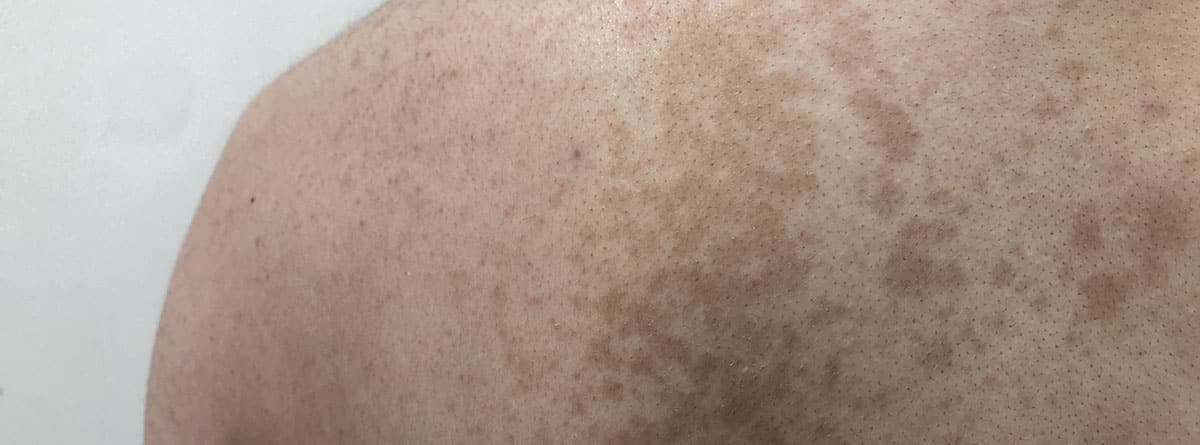 Pitiriasis versicolor¿es una enfermedad contagiosa? -canalSALUD