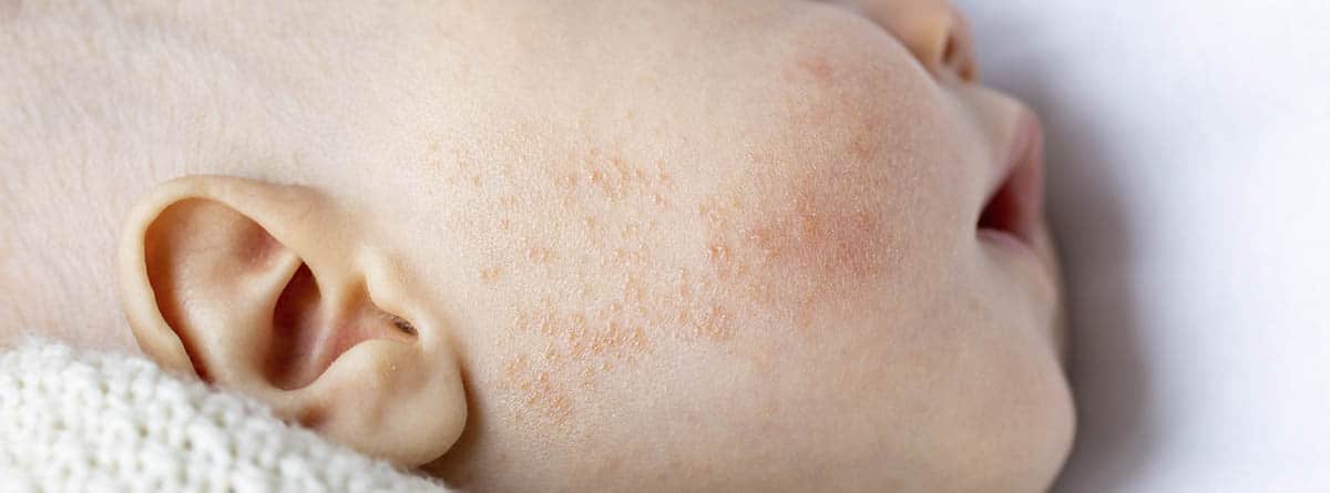 Qué son las vesículas de succión en bebés- Blog Salud MAPFRE