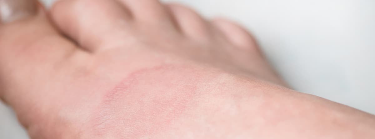 Granuloma anular: qué es y por qué se produce -canalSALUD