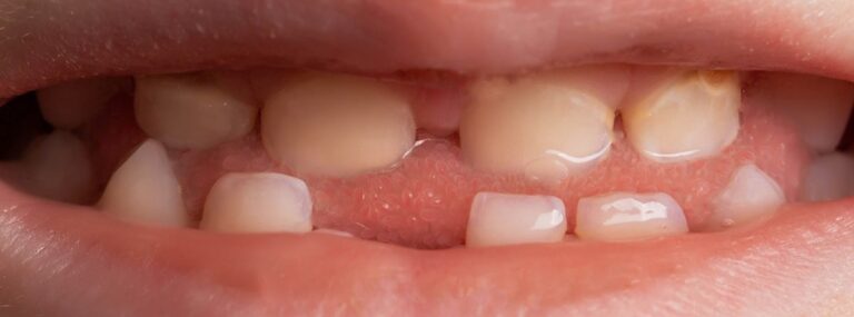 Agenesia dental: tipos, causas y tratamientos -canalSALUD
