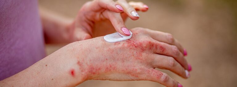 Dermatitis en las manos, ¿cómo curarla? -Blogs MAPFRE