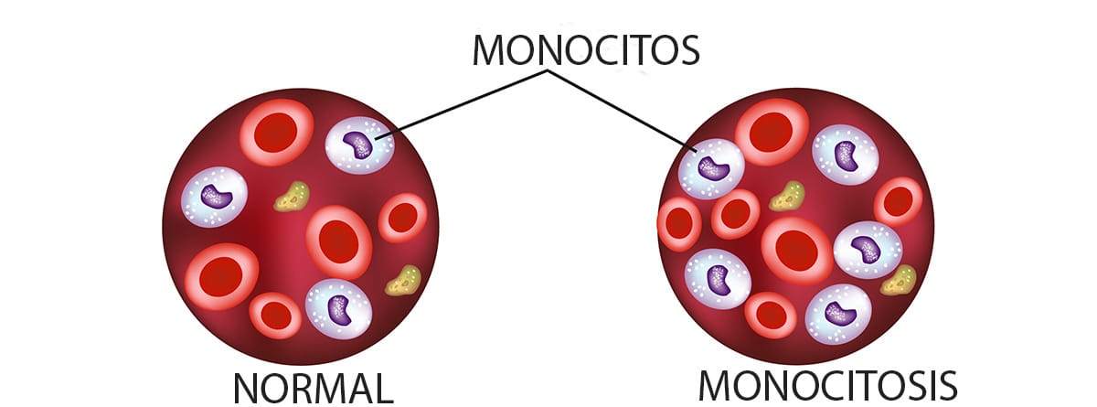 Monocitosis, causas y tratamiento- Blogs MAPFRE