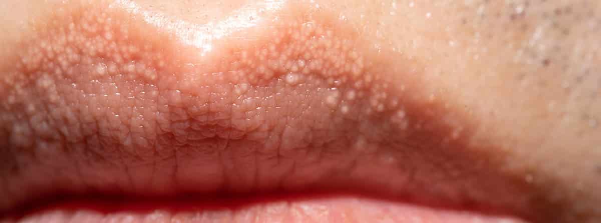 Qué son los granos de Fordyce - Blogs MAPFRE