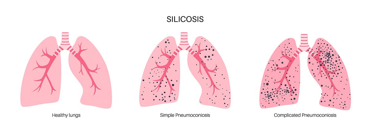 Silicosis: qué es, causas, síntomas y cura - Blogs MAPFRE