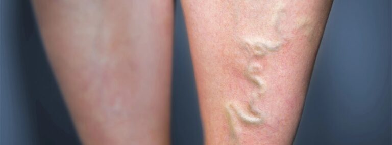 Qué es una flebitis - Blogs MAPFRE